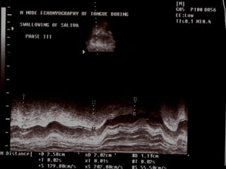 Echomyography of tongue | PPT