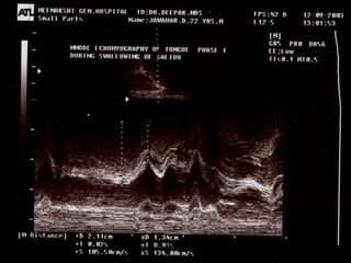 Echomyography of tongue | PPT