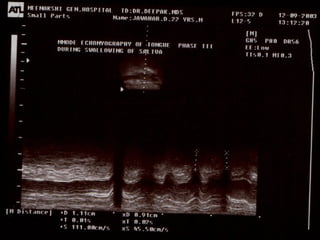 Echomyography of tongue | PPT