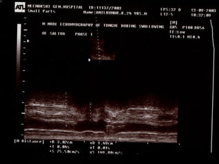 Echomyography of tongue | PPT