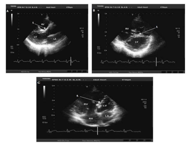 Echo of repaired tof