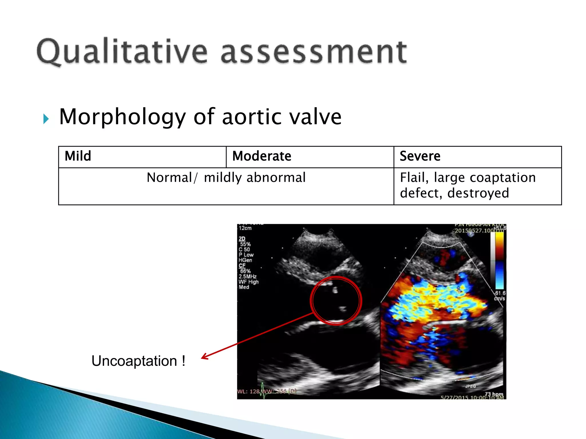 echo pada penyakit jantung katup final.pptx