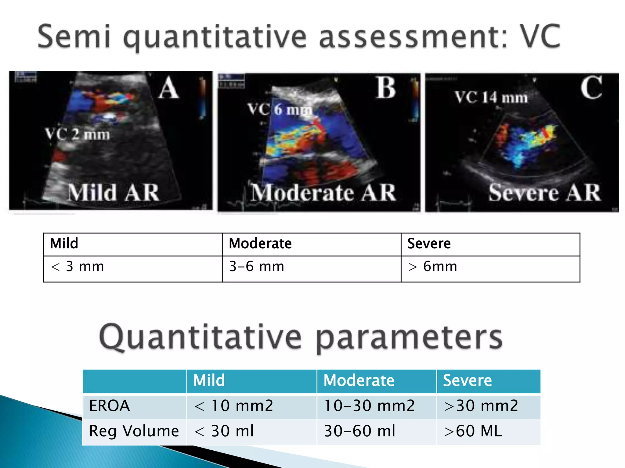 echo pada penyakit jantung katup final.pptx