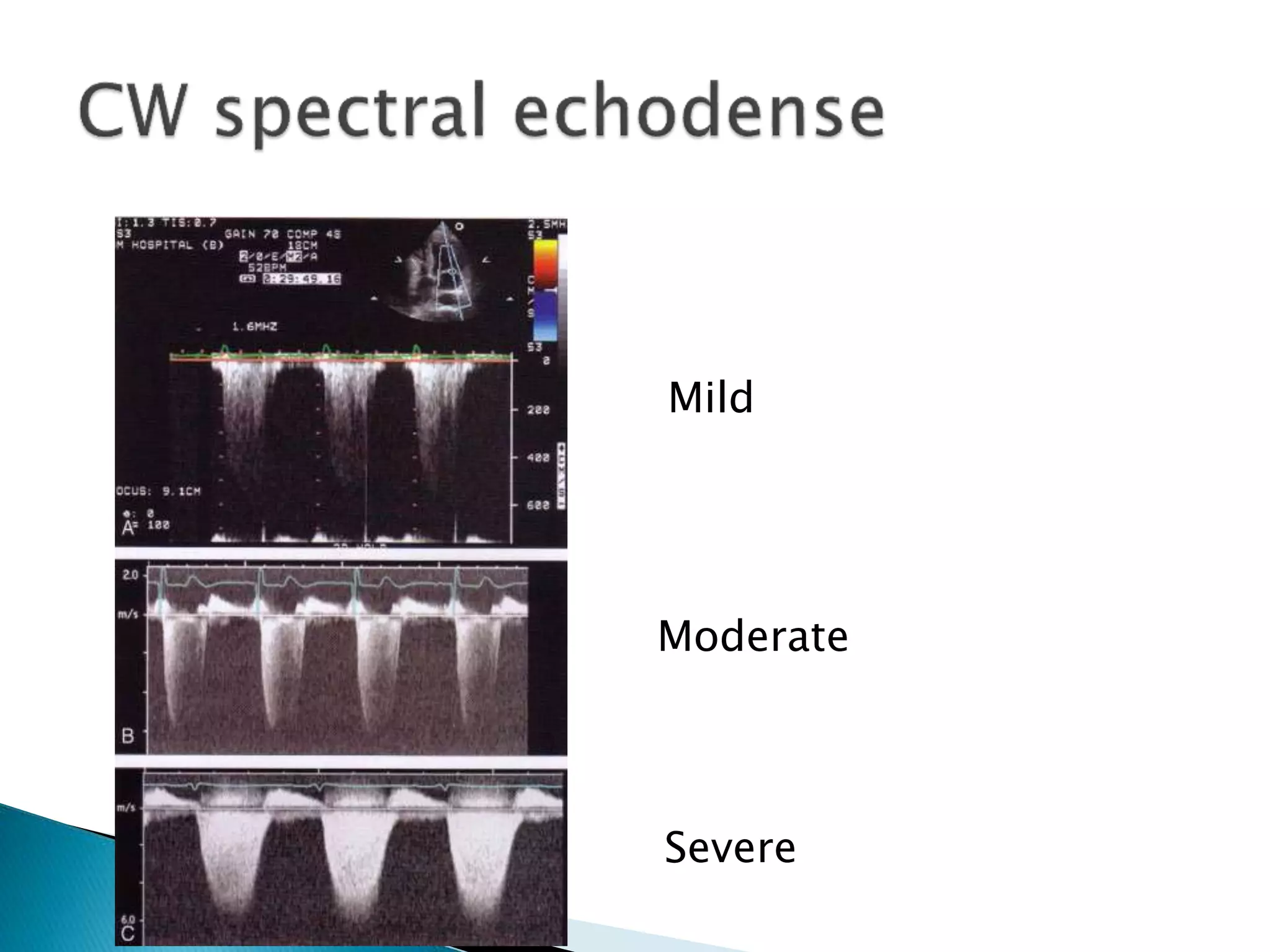 echo pada penyakit jantung katup final.pptx