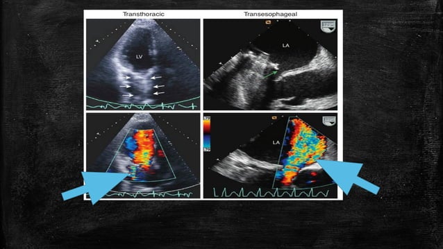 ECHO IN THE ASSESSMENT OF PROSTHETIC HEART VALVE.pptx