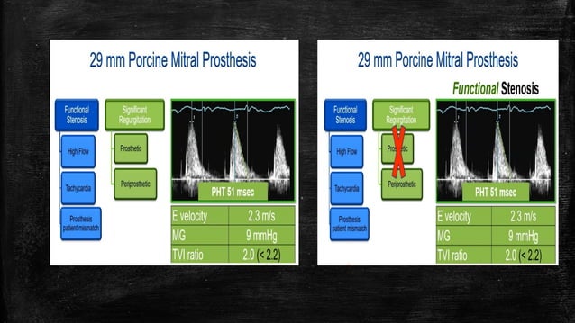 ECHO IN THE ASSESSMENT OF PROSTHETIC HEART VALVE.pptx