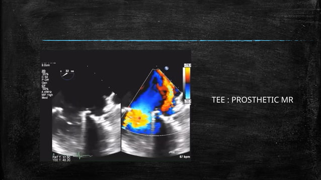 ECHO IN THE ASSESSMENT OF PROSTHETIC HEART VALVE.pptx