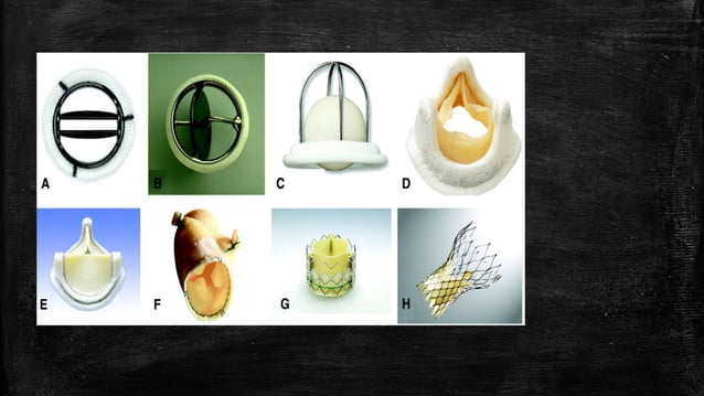 ECHO IN THE ASSESSMENT OF PROSTHETIC HEART VALVE.pptx