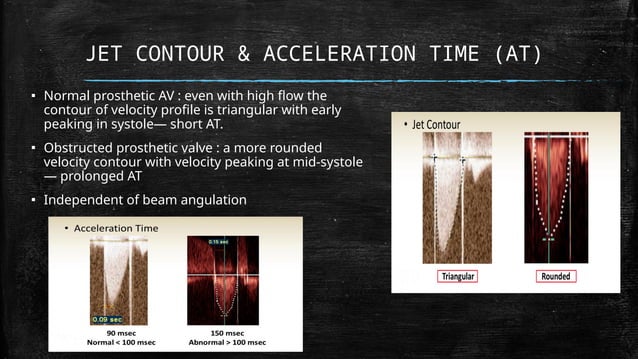 ECHO IN THE ASSESSMENT OF PROSTHETIC HEART VALVE.pptx