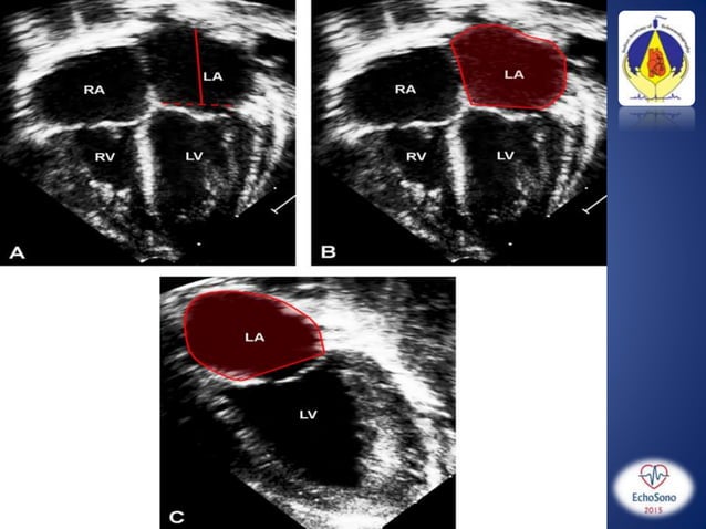 pediatric echo measurements technique z score | PPTX | Heart and ...