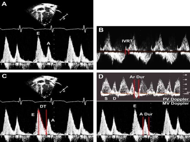pediatric echo measurements technique z score | PPTX | Heart and ...