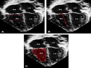 pediatric echo measurements technique z score | PPTX