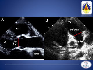 pediatric echo measurements technique z score | PPTX
