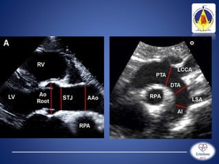 pediatric echo measurements technique z score | PPTX