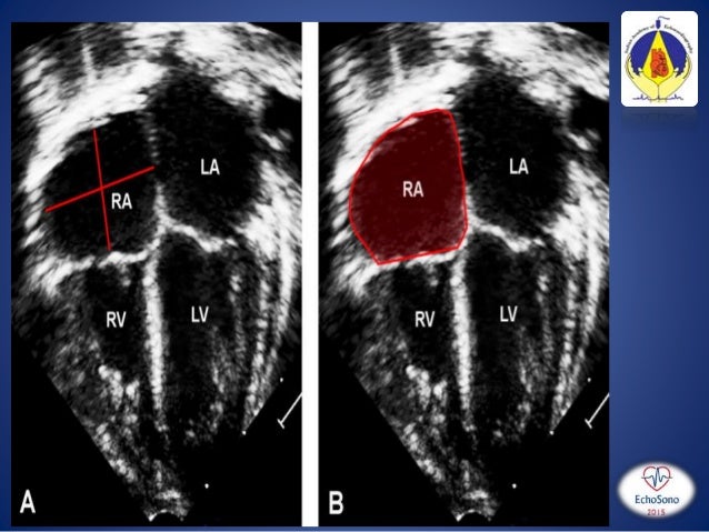 pediatric echo measurements technique z score