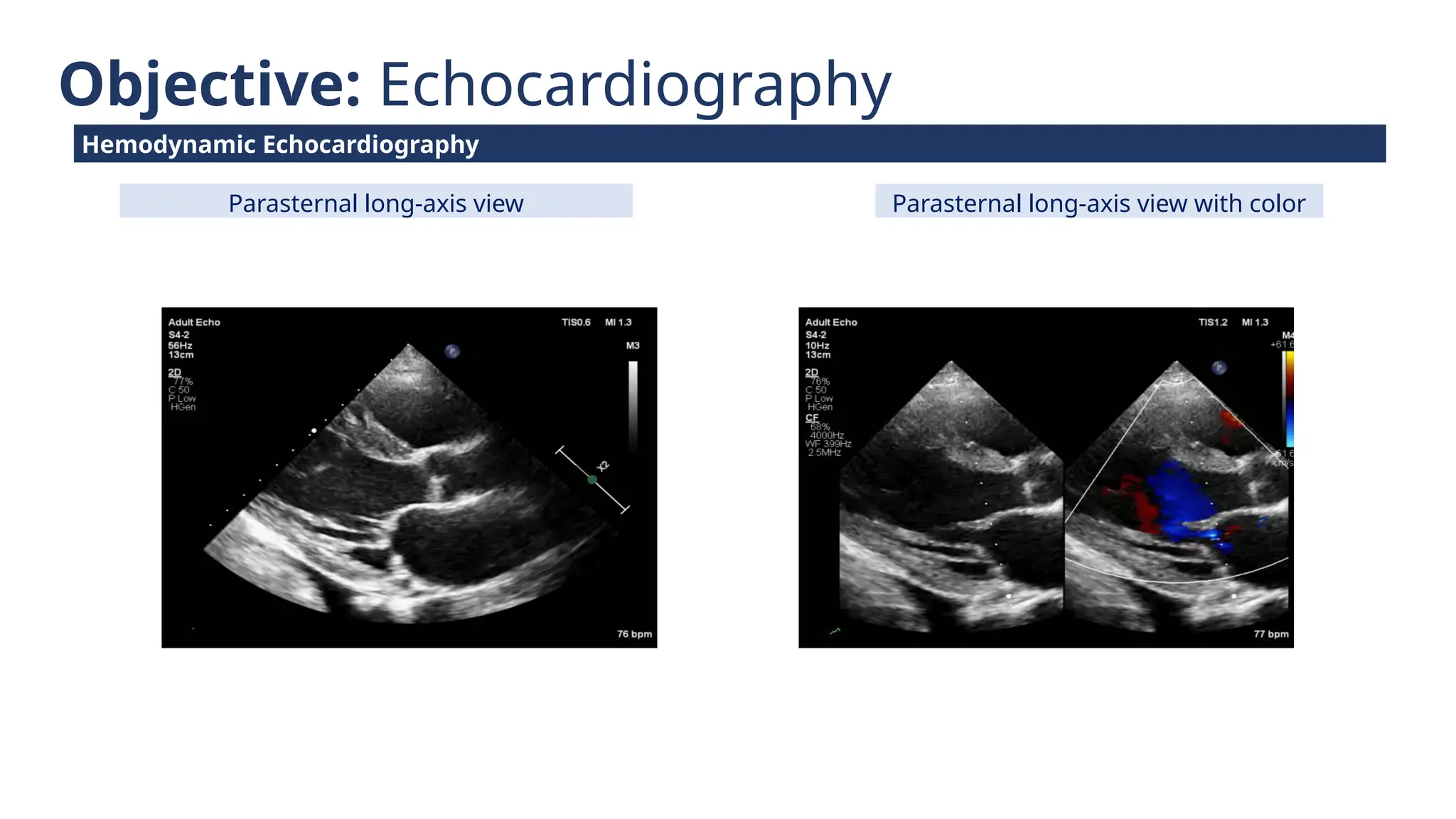 Echocardiography NH copy RWMA new ll.pptx