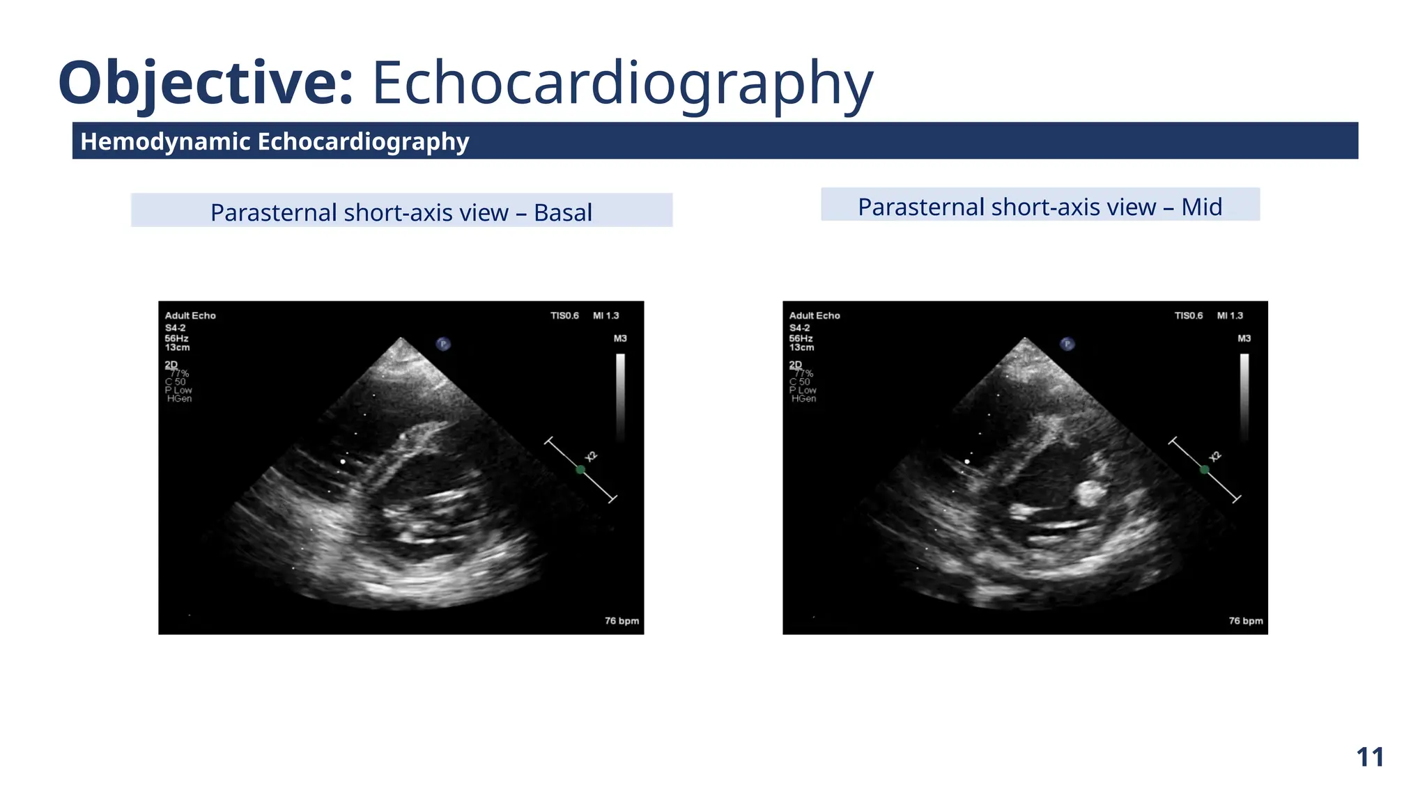 Echocardiography NH copy RWMA new ll.pptx