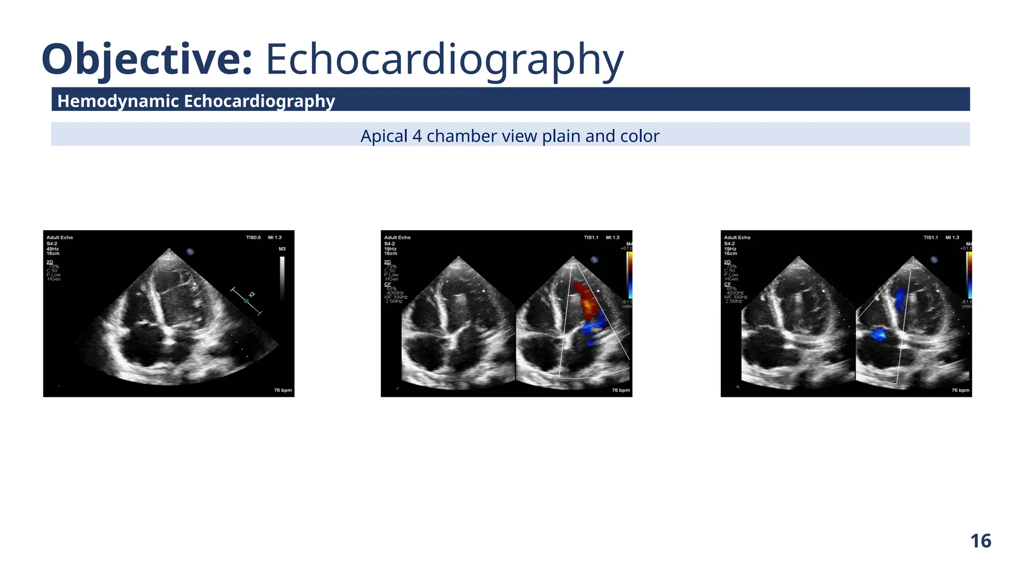 Echocardiography NH copy RWMA new ll.pptx