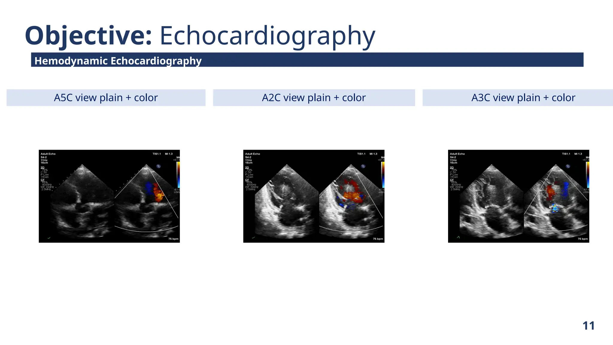 Echocardiography NH copy RWMA new ll.pptx