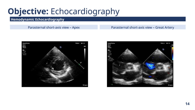 Echocardiography NH copy RWMA new ll.pptx
