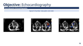 Echocardiography NH copy RWMA new ll.pptx