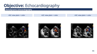 Echocardiography NH copy RWMA new ll.pptx