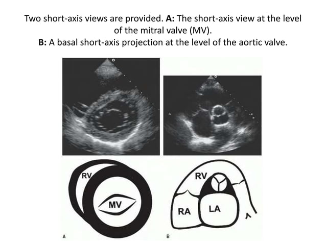 Echo views | PPTX | Heart and Cardiovascular Diseases | Diseases and ...
