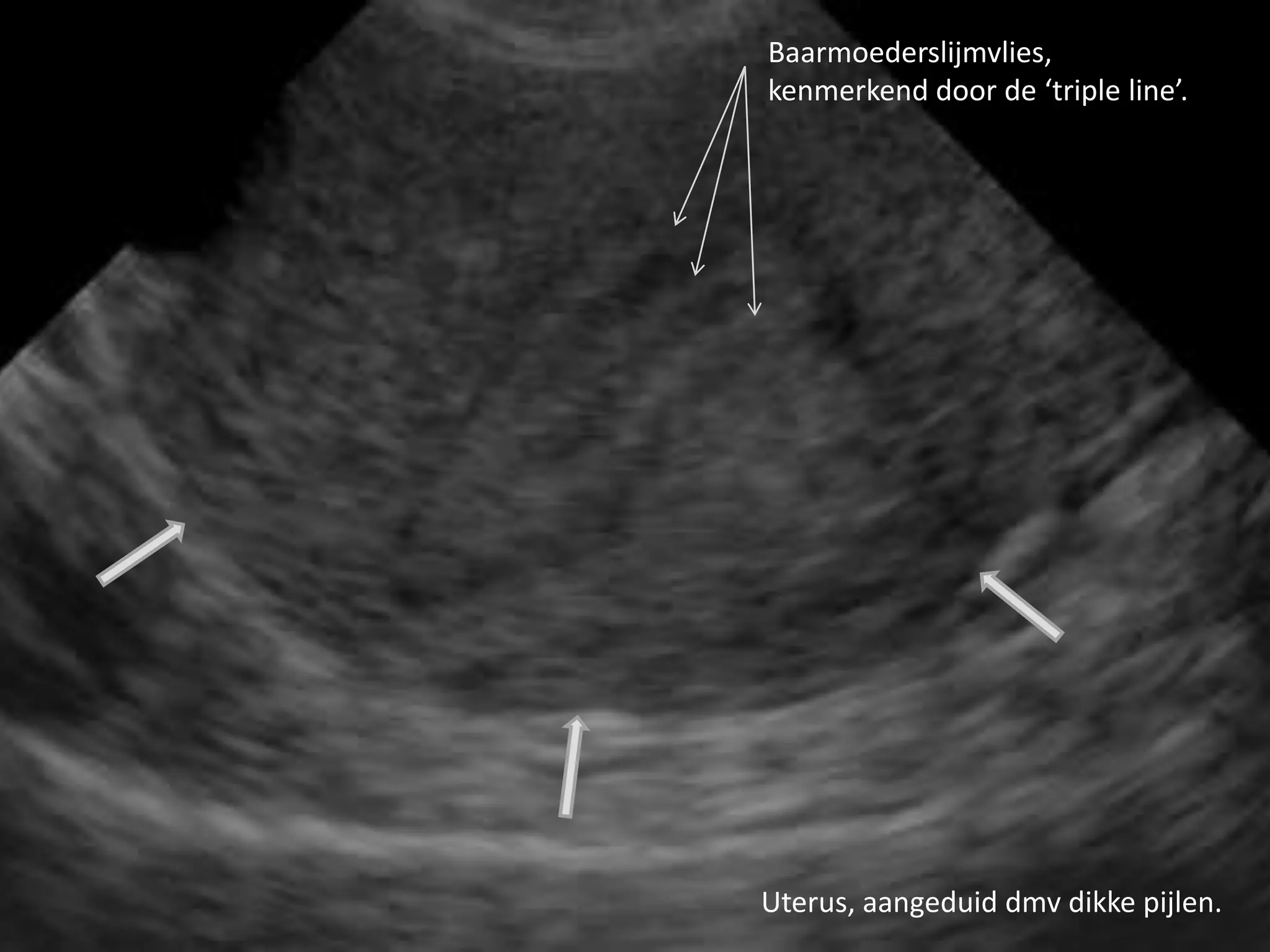 Echo, voor inspuiting met pregnyl | PPTX