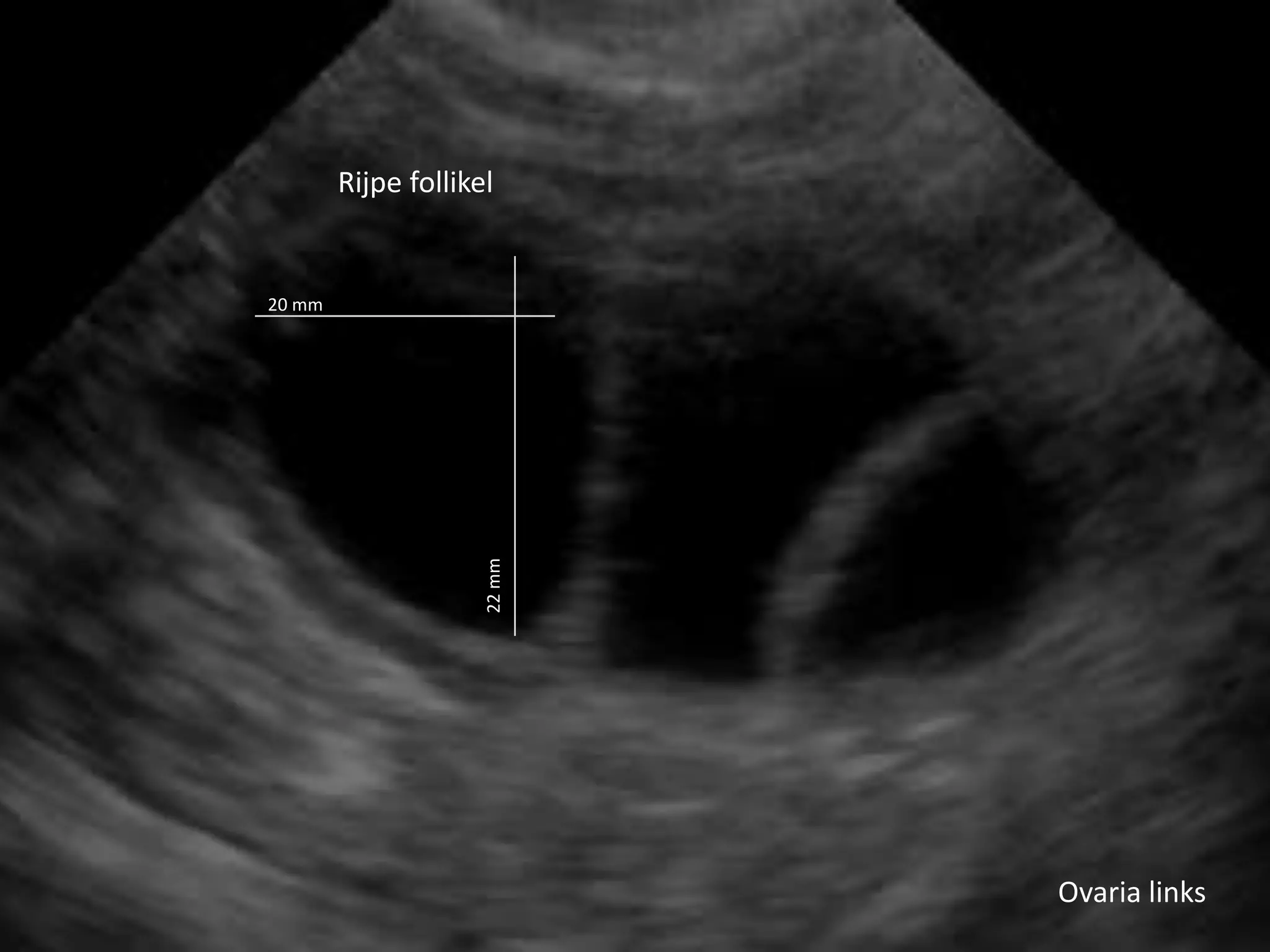 Echo, voor inspuiting met pregnyl | PPTX