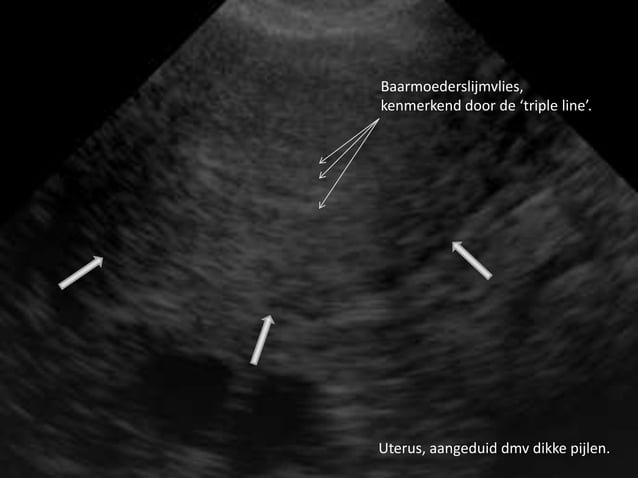 Echo, voor inspuiting met pregnyl | PPTX