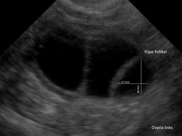 Echo, voor inspuiting met pregnyl | PPTX