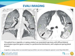 E cigarettes vaping and vaping induced lung injury EVALI | PPTX