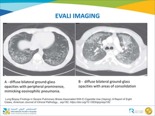 E cigarettes vaping and vaping induced lung injury EVALI | PPTX