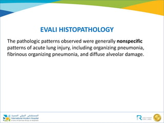 E cigarettes vaping and vaping induced lung injury EVALI | PPTX