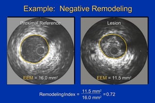 142 arterial remodelling in coronary syndromes | PPT