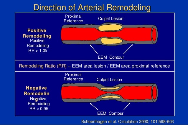142 arterial remodelling in coronary syndromes