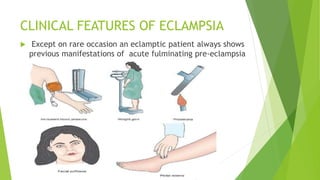Eclampsia case presentaion | PPTX