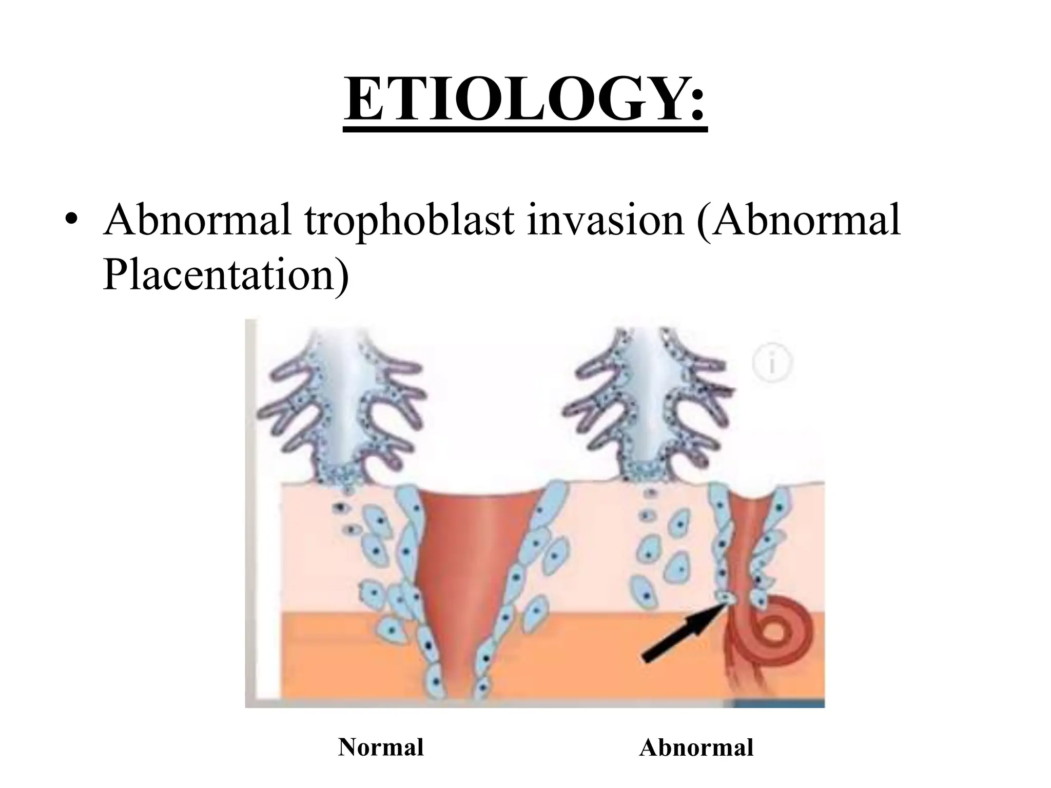 Eclampsia.pptx definition causes management | PPTX