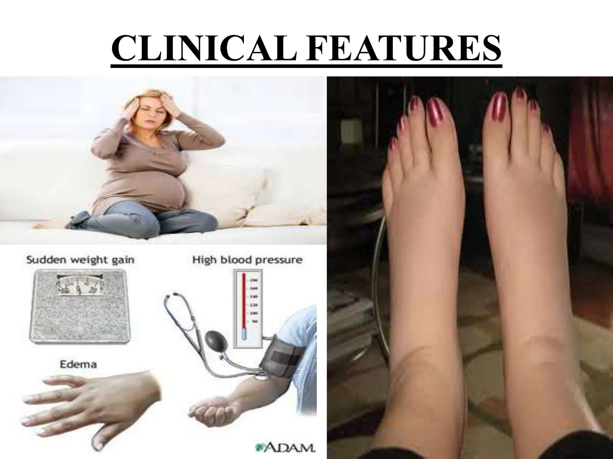 Eclampsia.pptx definition causes management | PPTX