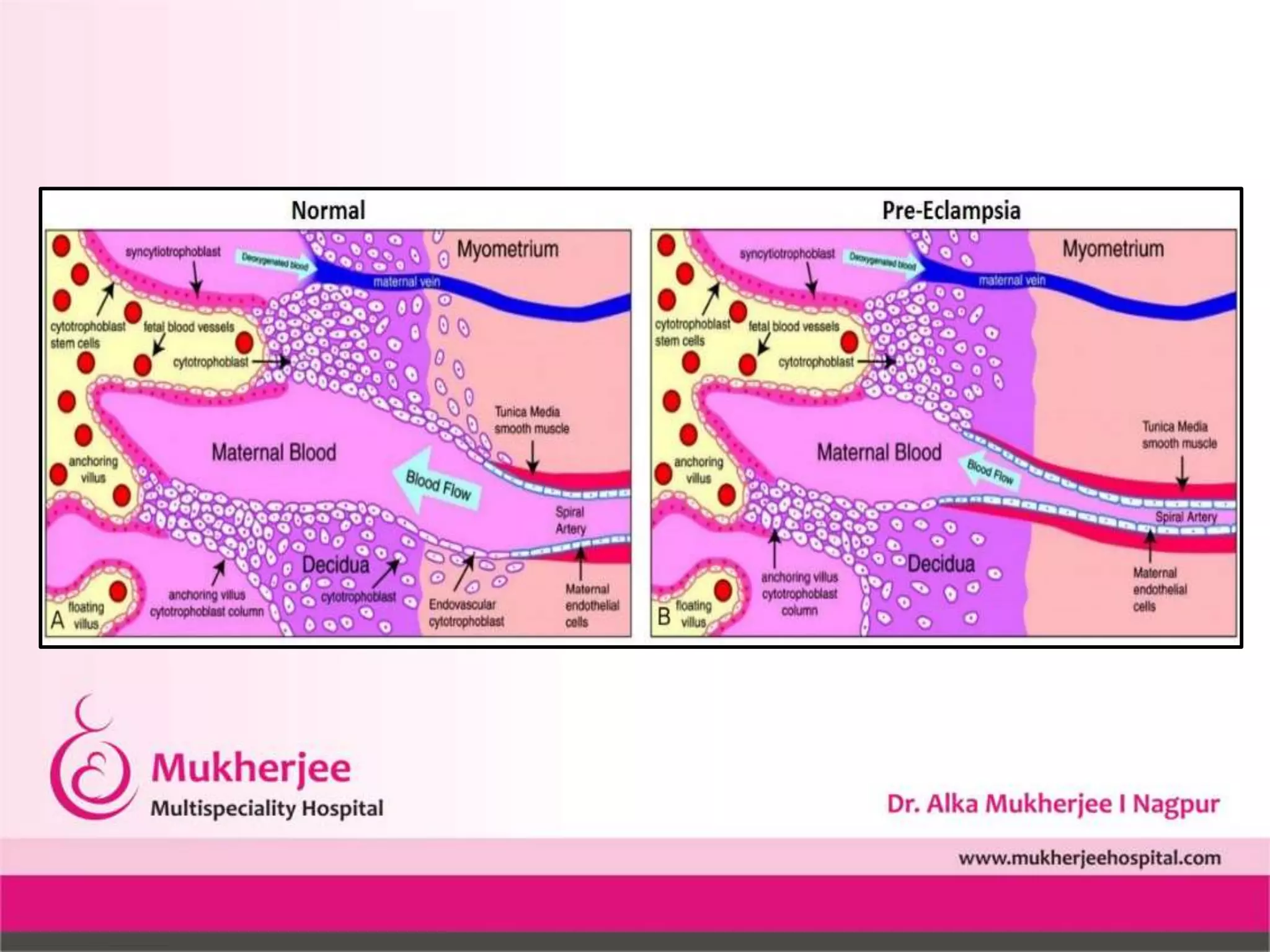 Eclampsia labor room protocol by dr alka mukherjee dr apurva mukherjee ...