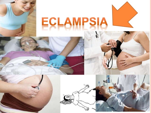 Eclampsia - Preeclampsia | PPT