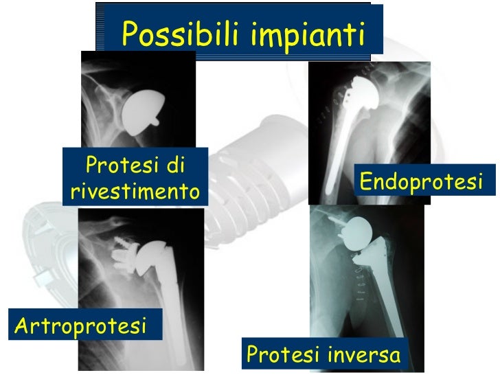 Protesi Spalla senza stelo