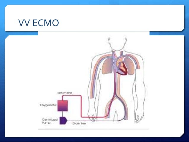 ECMO in Cardiac Arrest