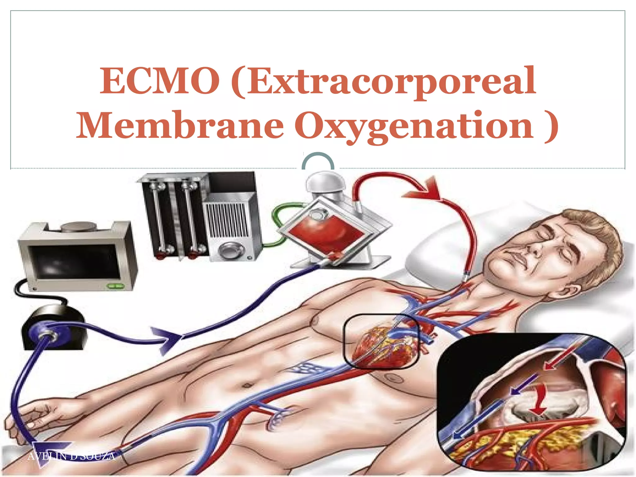 Ecmo | PPT