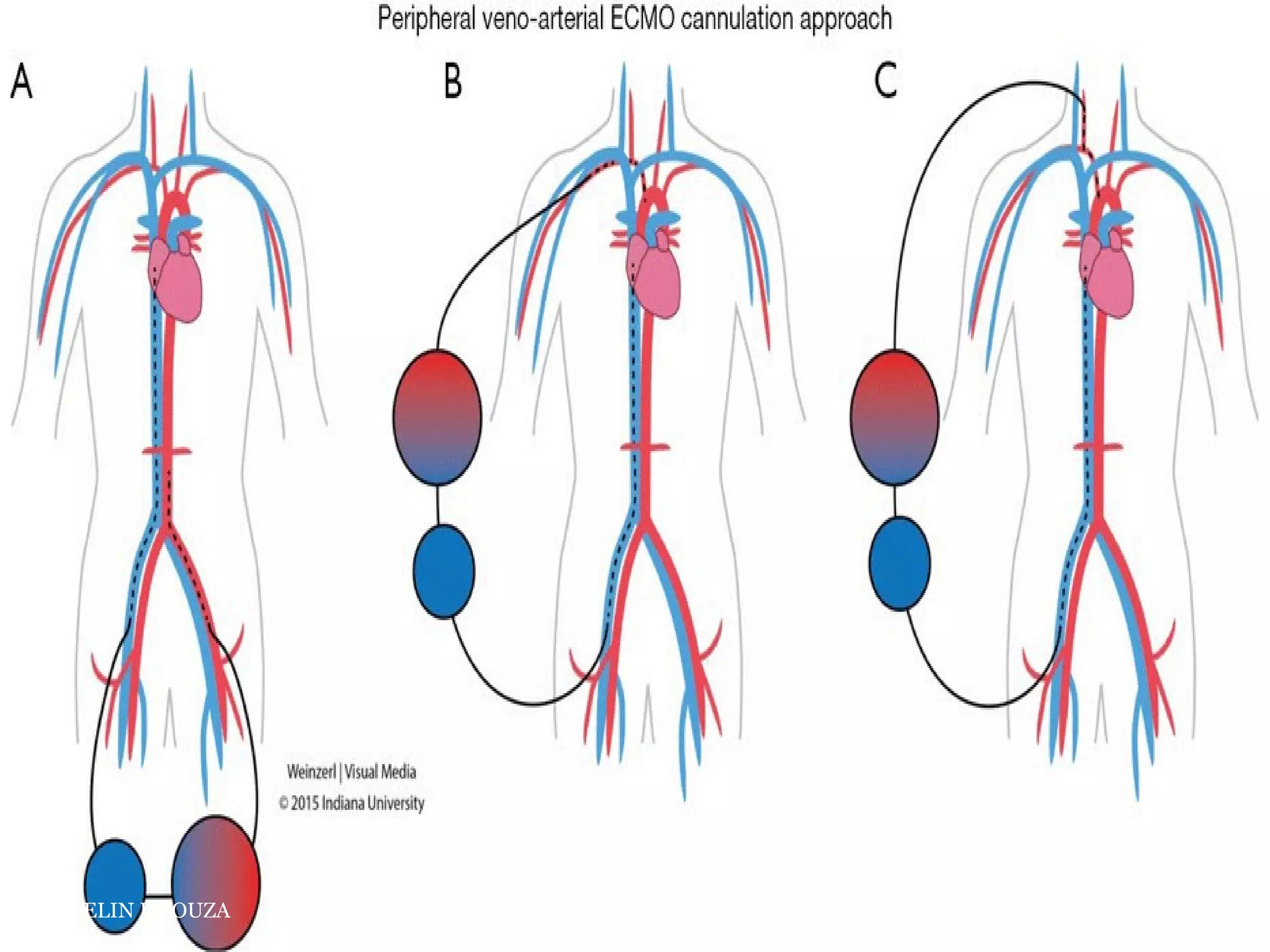 Ecmo | PPT
