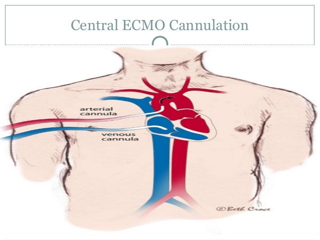 Ecmo
