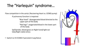 Ecmo | PPTX