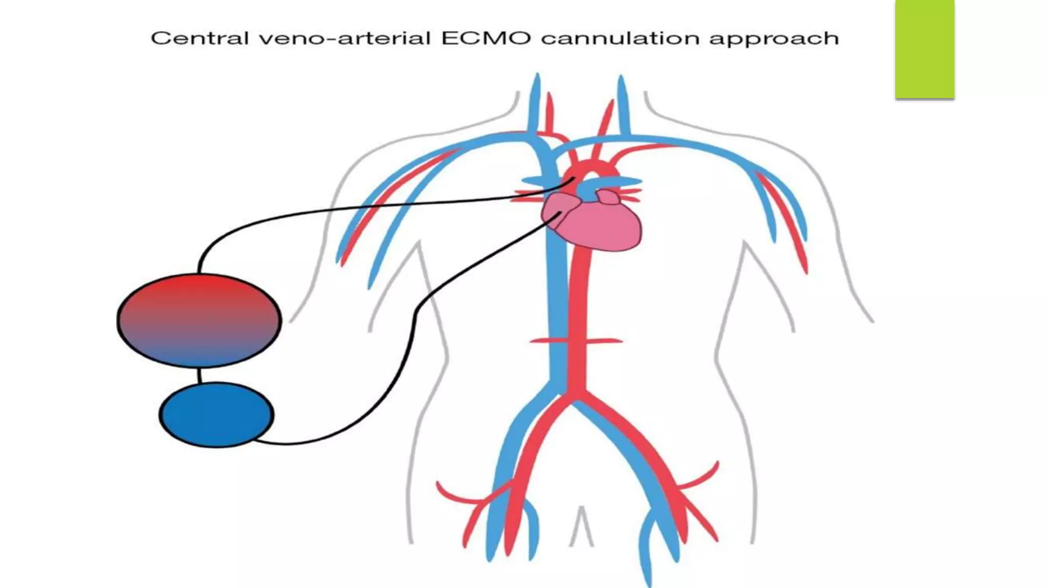 Ecmo (Extracorporeal membrane oxygenation) | PPTX