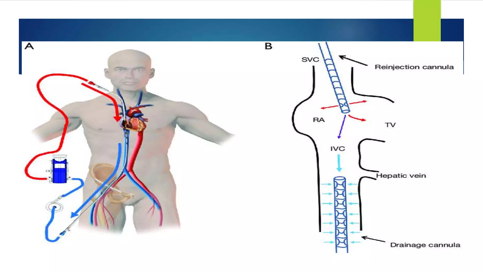 Ecmo (Extracorporeal membrane oxygenation) | PPTX