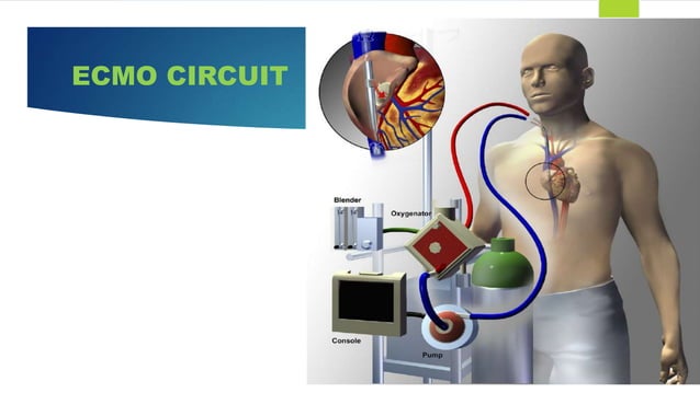 Ecmo (Extracorporeal membrane oxygenation) | PPTX | First Aid | Injuries